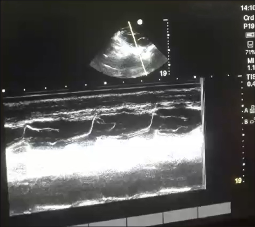 Electrocardiographic Manifestations of Yellow Oleander Poisoning in ...